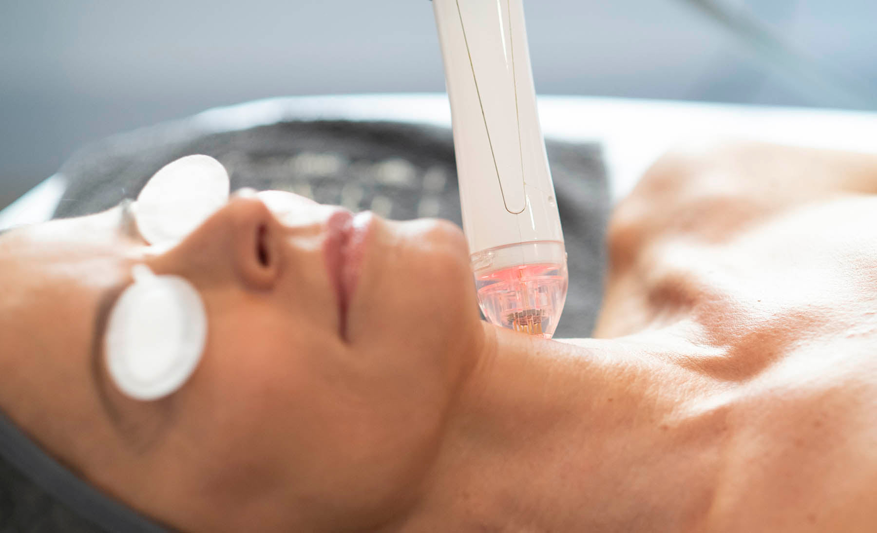 The Most Common Vivace® Rf Microneedling Questions Answered